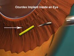 Rx Item-Ozurdex 0.7Mg Implant 1 By Allergan Pharma