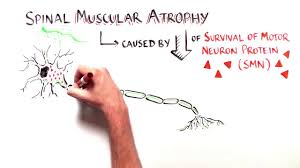 Rx Item-Spinraza (Nusinersen) Intrathecal Inj 2.4Mg/Ml By Biogen